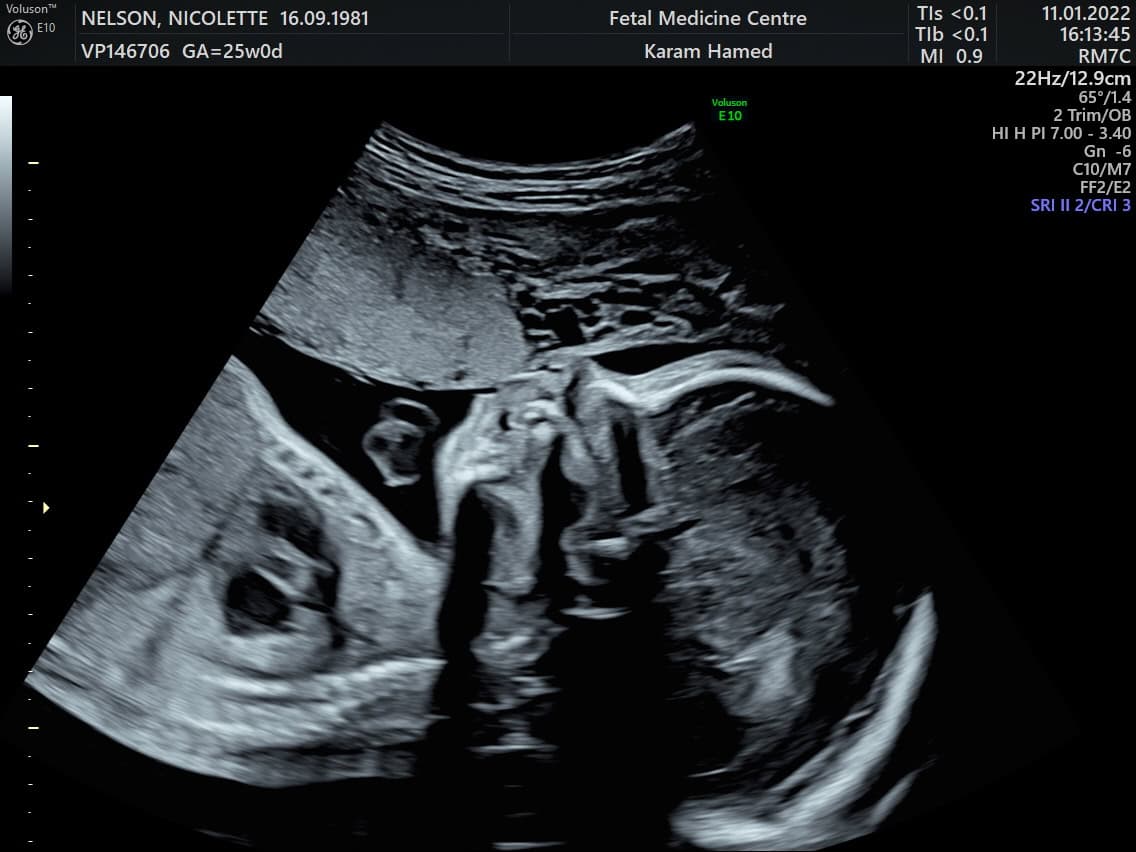 Anomaly Scan The Fetal Medicine Centre